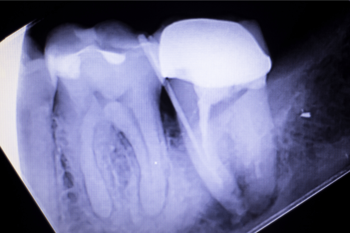 Warning Signs of Tooth Decay Under a Crown